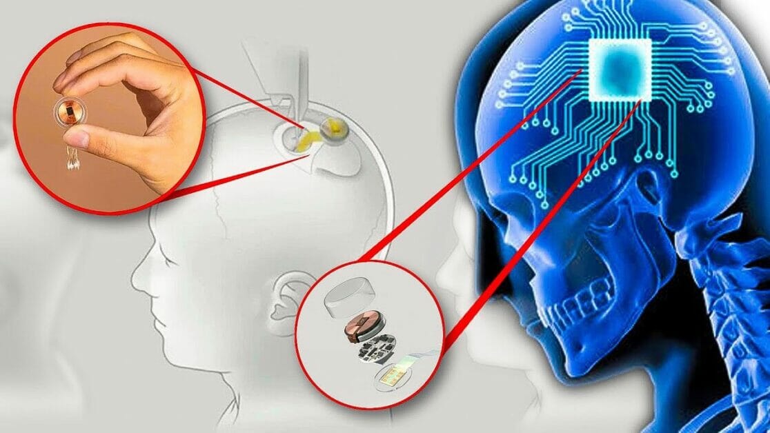 Neuralink, Elon Musk's Company, Will Begin Brain Chip Trials in Humans ...
